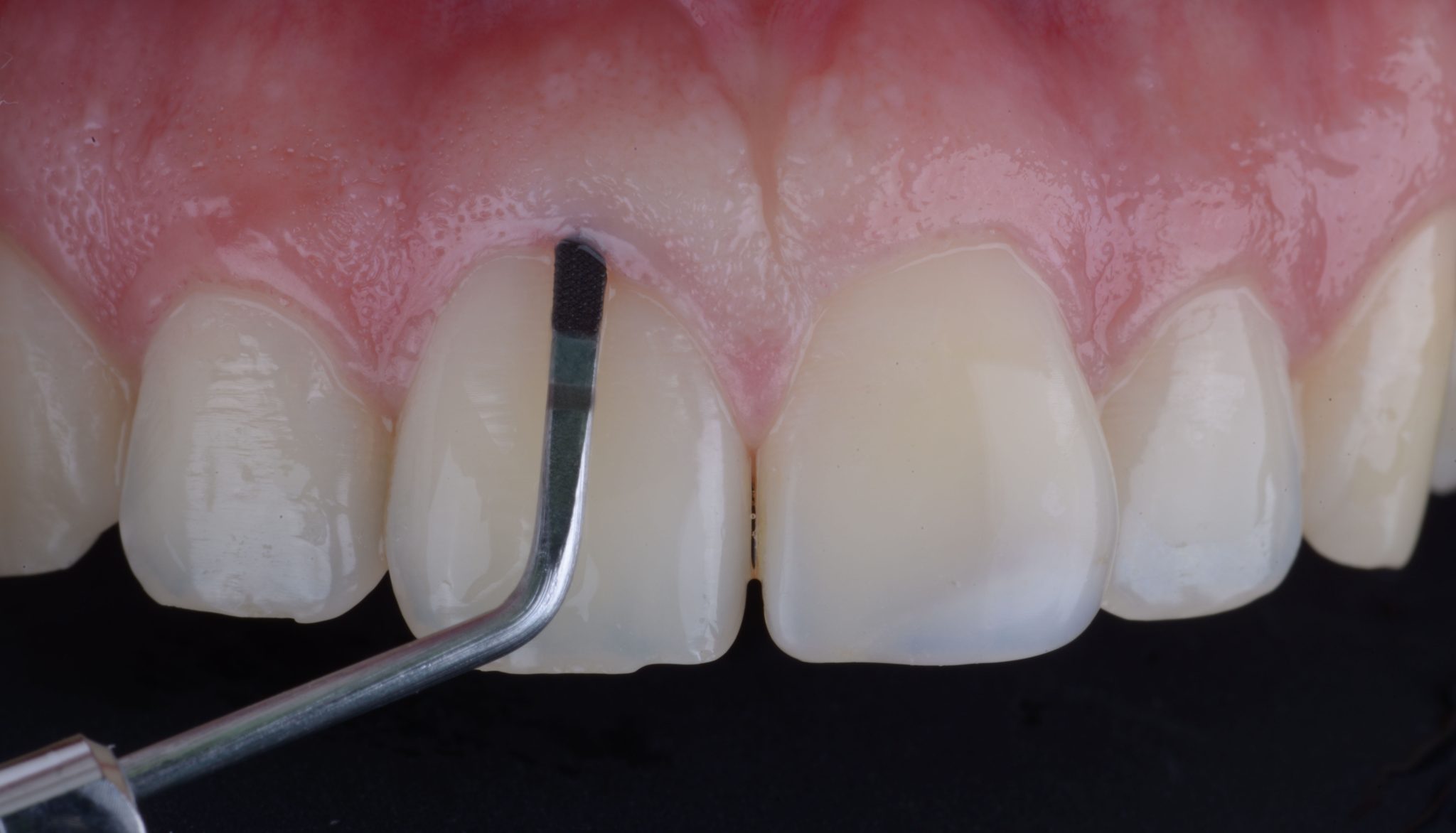 Kit Preparo Protético - CVDentus